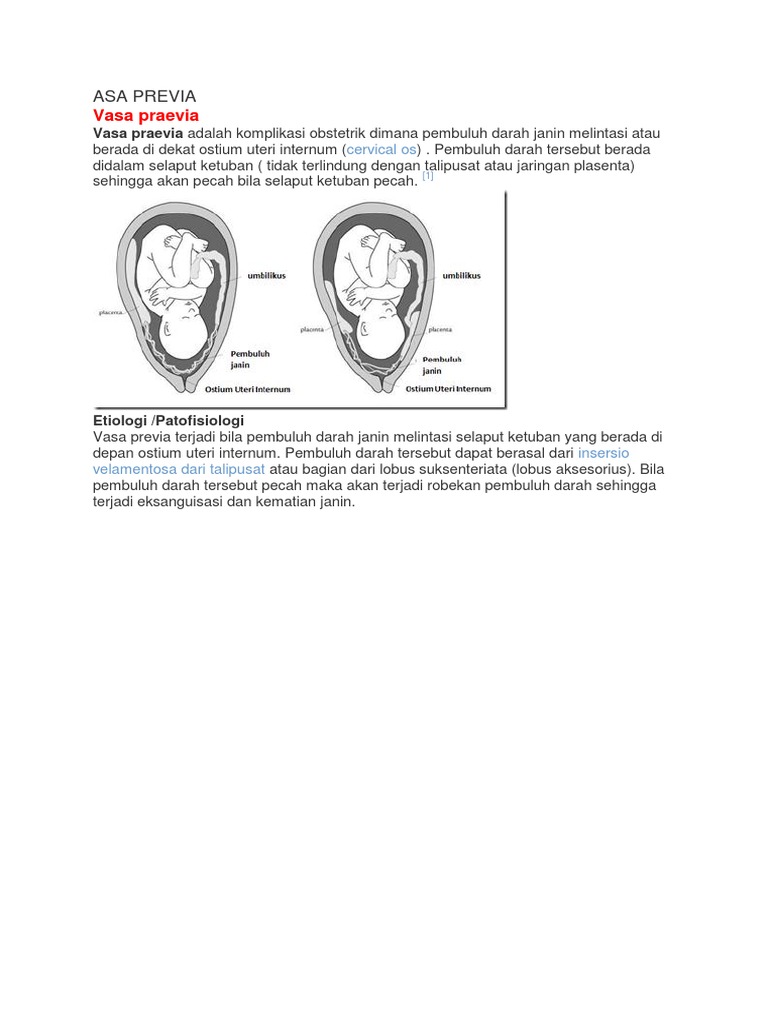 Vasa Previa | PDF