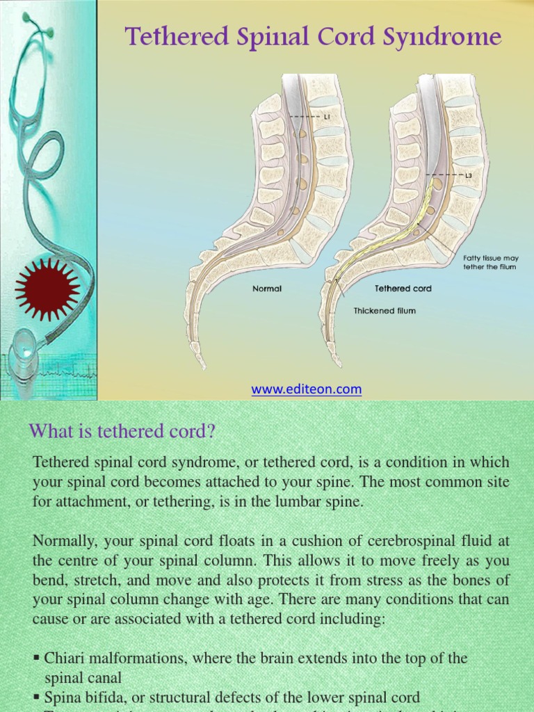 Tethered Spinal Cord Syndrome | PDF | Vertebral Column | Diseases And ...