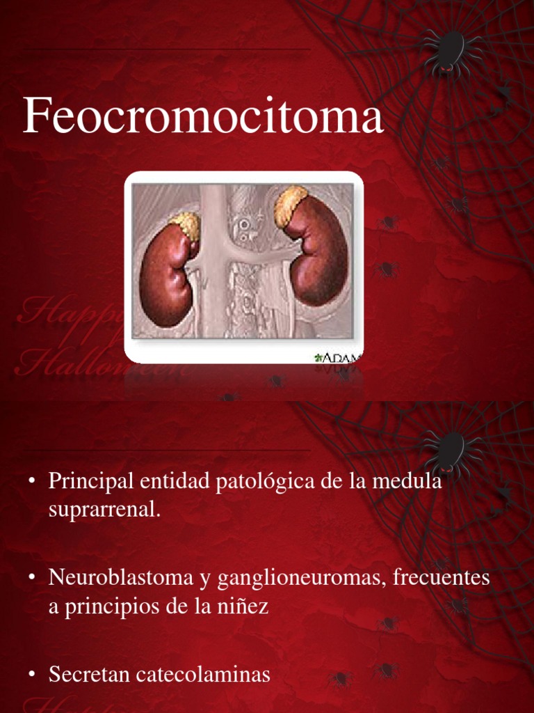 Feocromocitoma | Hipertensión | Especialidades Medicas