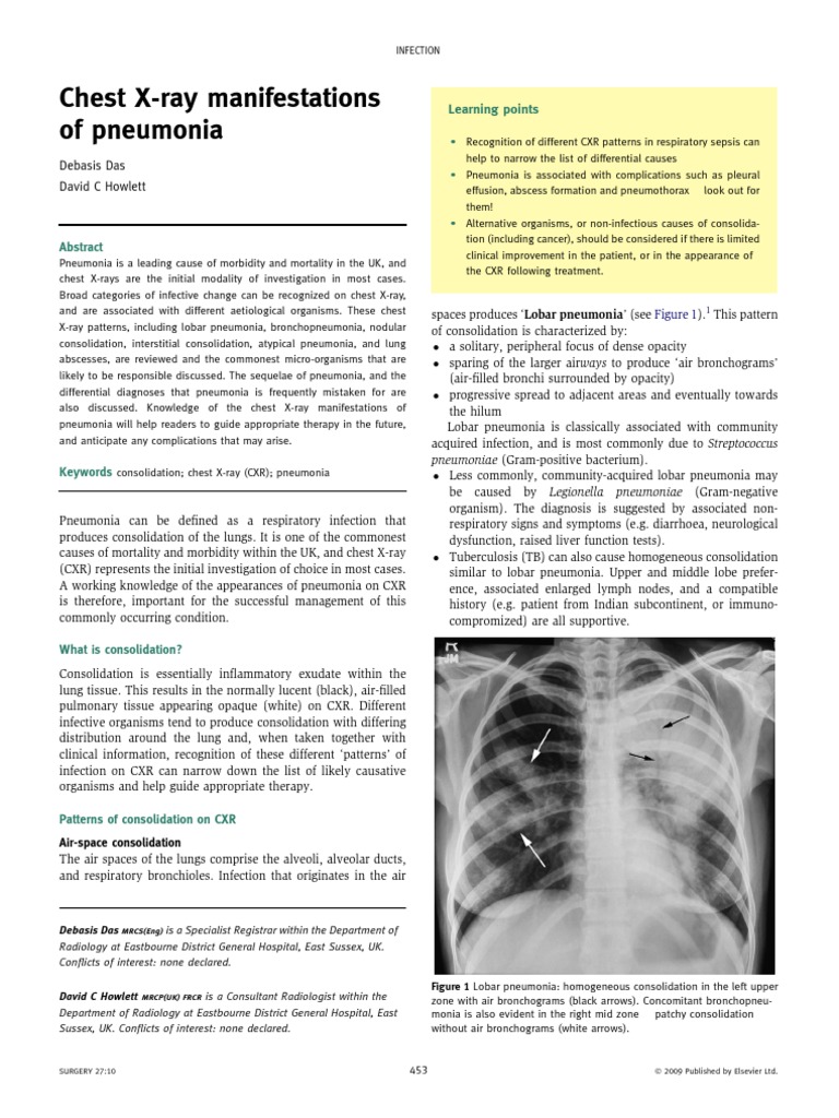 Chest X-Ray Manifestations of Pneumonia | PDF | Pneumonia | Lung