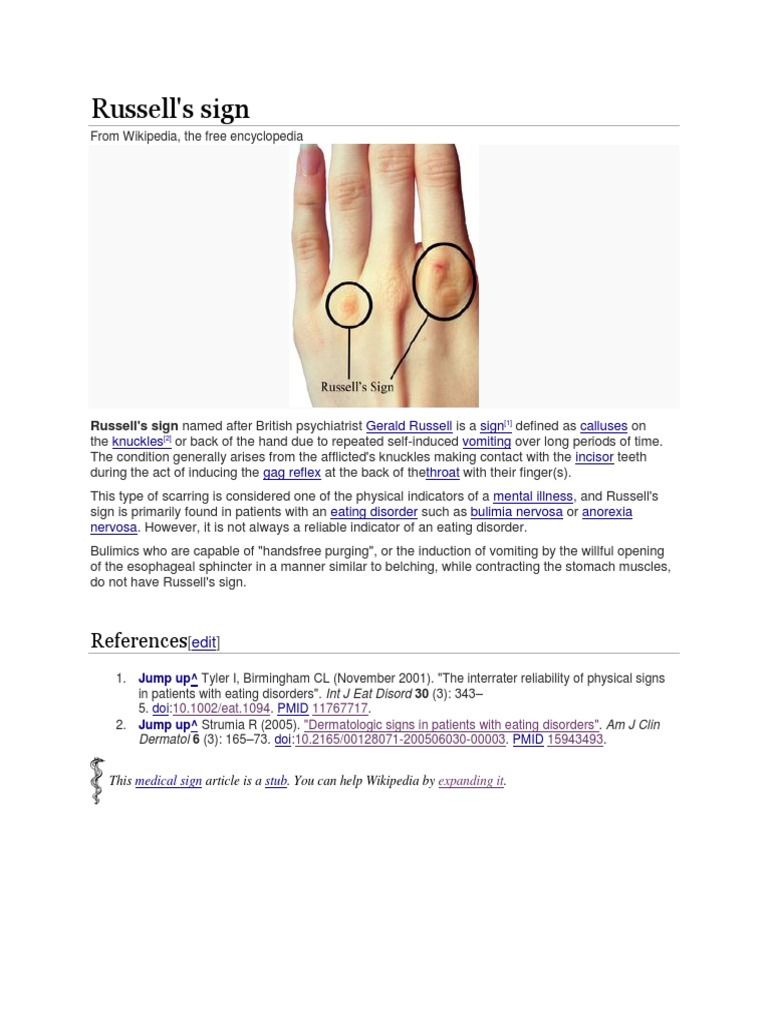 Russell's Sign: References | PDF | Bulimia Nervosa | Eating Disorder