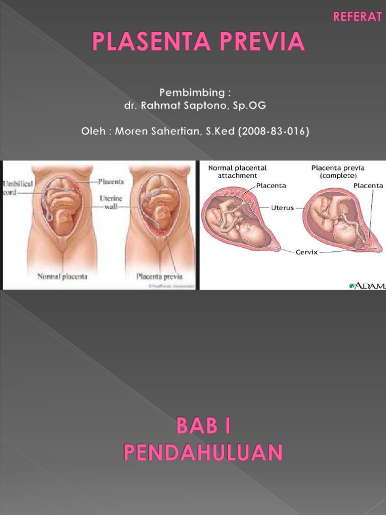 Plasenta Previa | PDF
