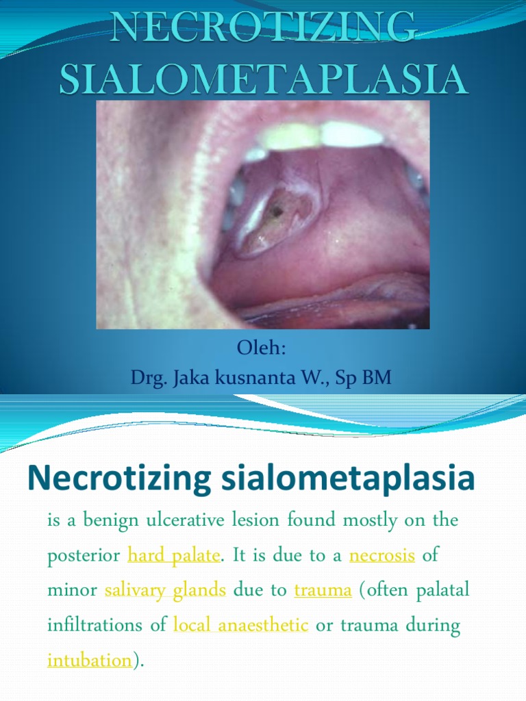 Necrotizing Sialometaplasia Overview | PDF | Necrosis | Biopsy