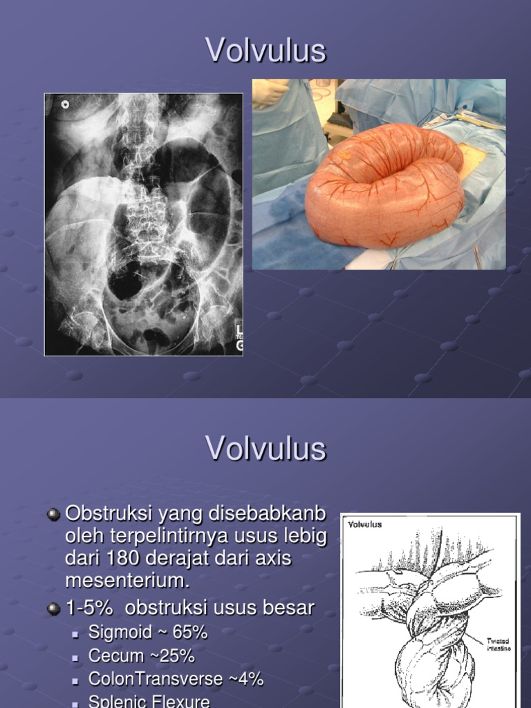Volvulus | PDF | Gastroenterologi | Obat