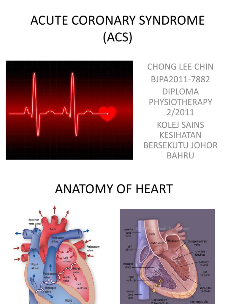 Acute Coronary Syndrome (Acs) | PDF | Myocardial Infarction | Angina ...