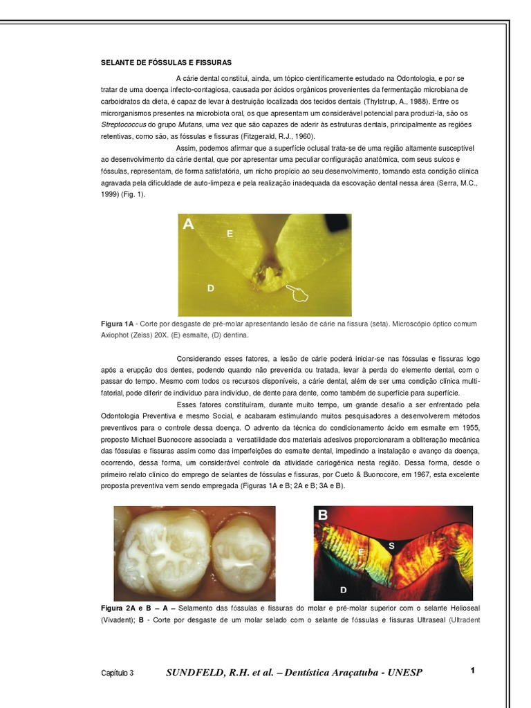 Selante de Fossulas e Fissuras Apostila | PDF | Dente | Boca