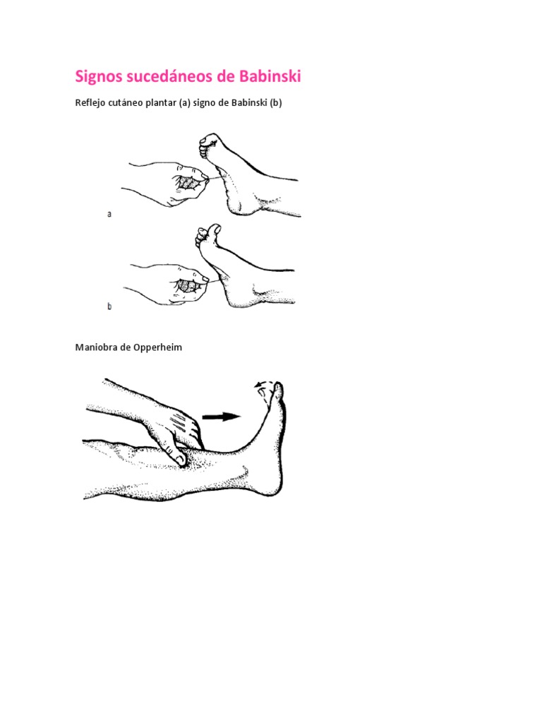 Signos sucedáneos de Babinski: Reflejo cutáneo plantar (a) signo de ...