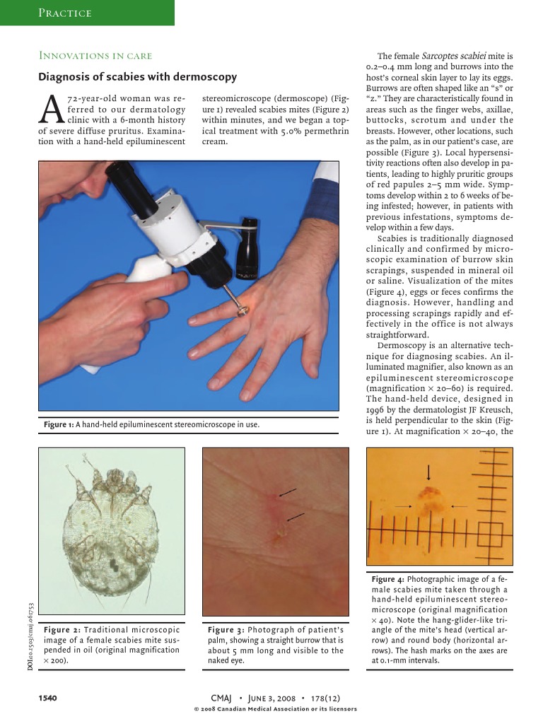 Diagnosis of Scabies With Dermoscopy | Health Care | Public Health