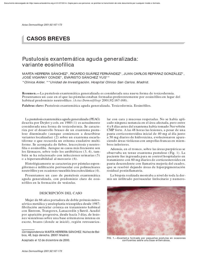 Pustulosis exantemática aguda generalizada.pdf | Medical Diagnosis ...