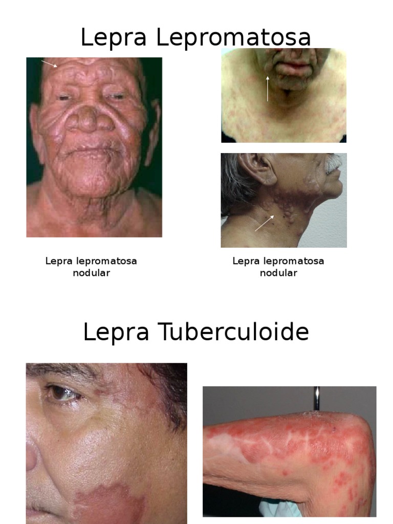 Lepra e Infecciones Producidas Por Virus | PDF | Ficción general
