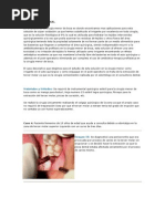 Protocolo de Exodoncia Temporal | PDF