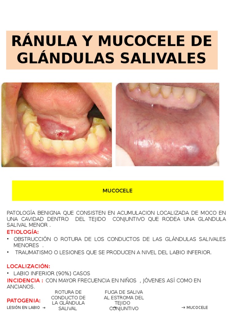 Ranula y Mucocele | PDF