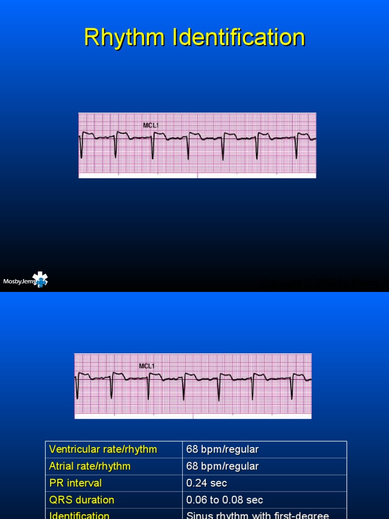 Practice ECGStrips | PDF | Heart Rate | Artificial Cardiac Pacemaker