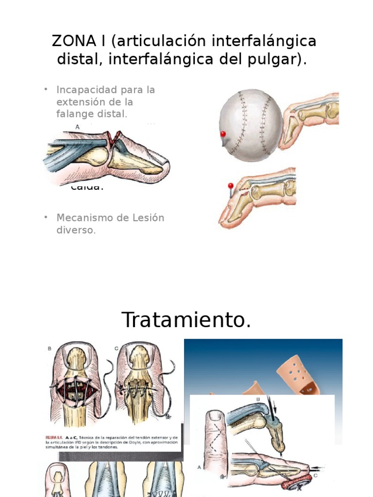 ZONA I (Articulación Interfalángica Distal, Interfalángica-2 | PDF ...