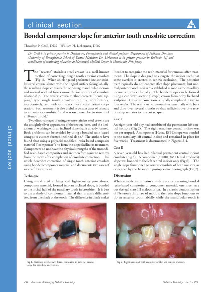 compomer crown | Dental Composite | Dentistry