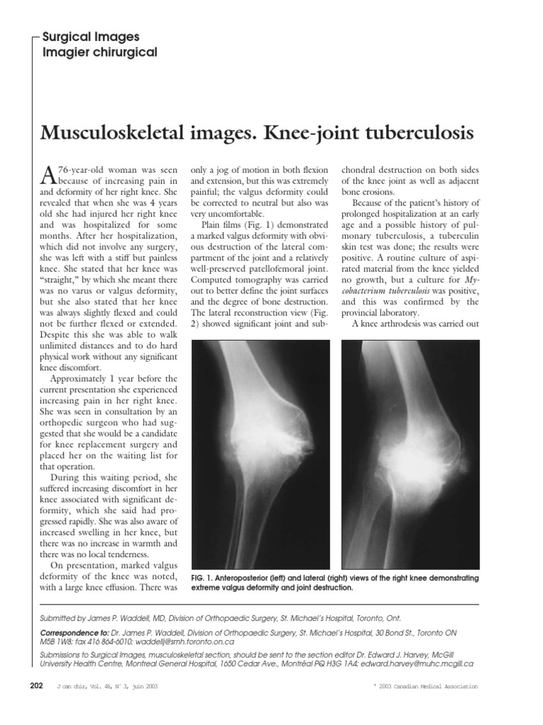 Musculoskeletal Images. Knee-Joint Tuberculosis: Surgical Images ...