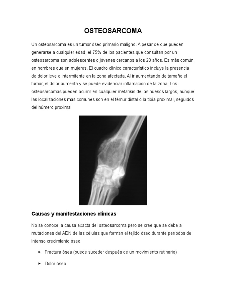 Osteosarcoma | Metástasis | Cáncer