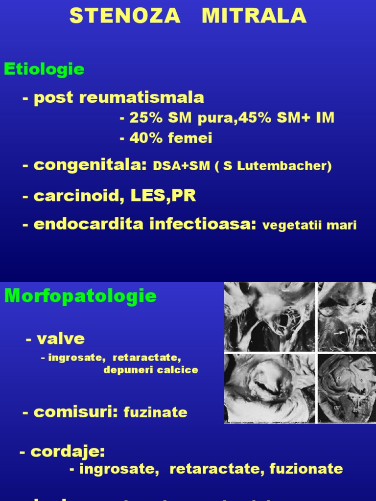 Mitral Stenosis: Clinical Insights | PDF