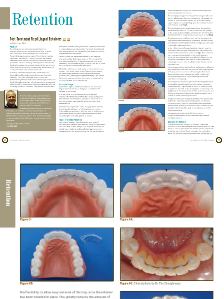 Retainer Lingiual Bonded Fixed PDF | PDF | Dental Composite | Orthodontics
