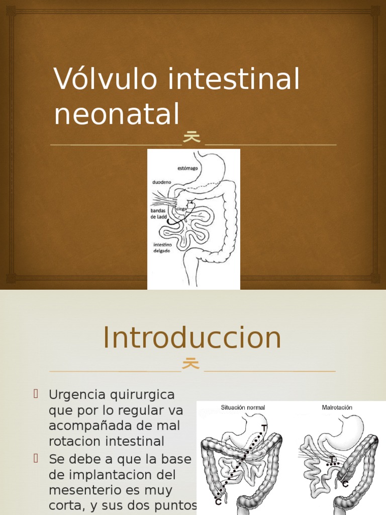 Vólvulo Intestinal Neonatal | PDF