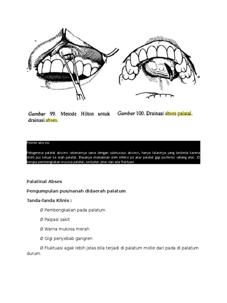 Palatal Abscess | PDF