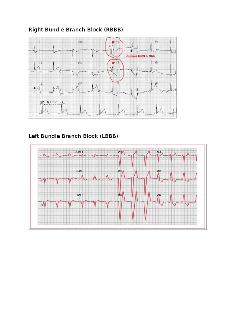 Tugas Ekg RBBB+LBBB RGN | PDF