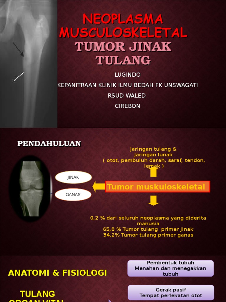 Tumor Tulang Jinak | PDF | Sistem Muskuloskeletal | Sistem Kerangka