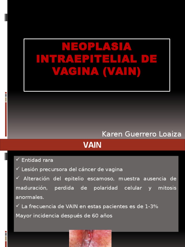 Neoplasia Intraepitelial de Vagina (Vain) | PDF