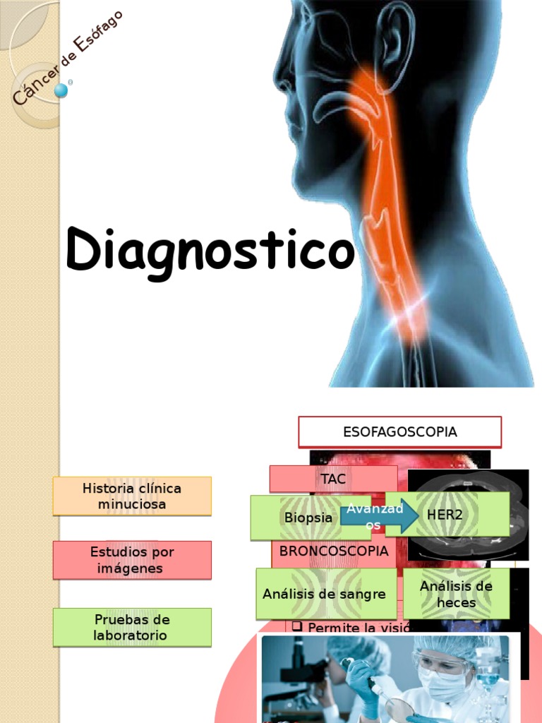 Cancer de Esofago ( Diagnostico y Tratamiento) | Descargar gratis PDF ...