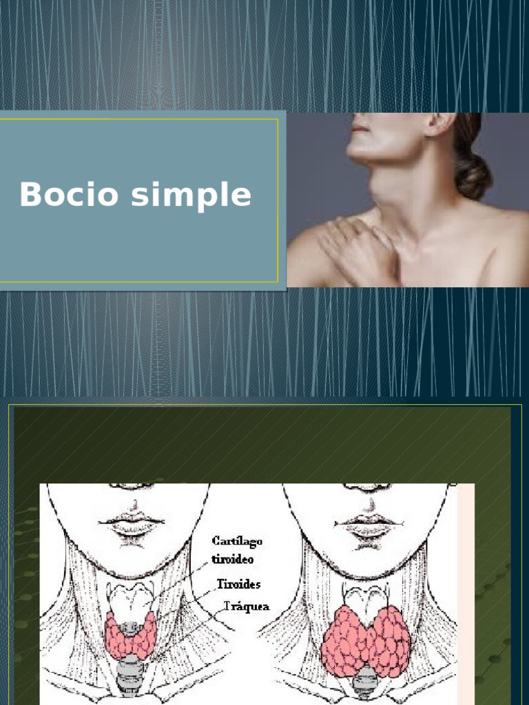 Bocio Simple | PDF