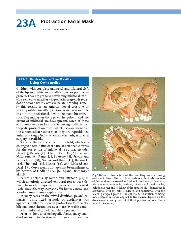 Protraction Facial Mask Corrects Midfacial Retrusion | PDF | Dentistry ...