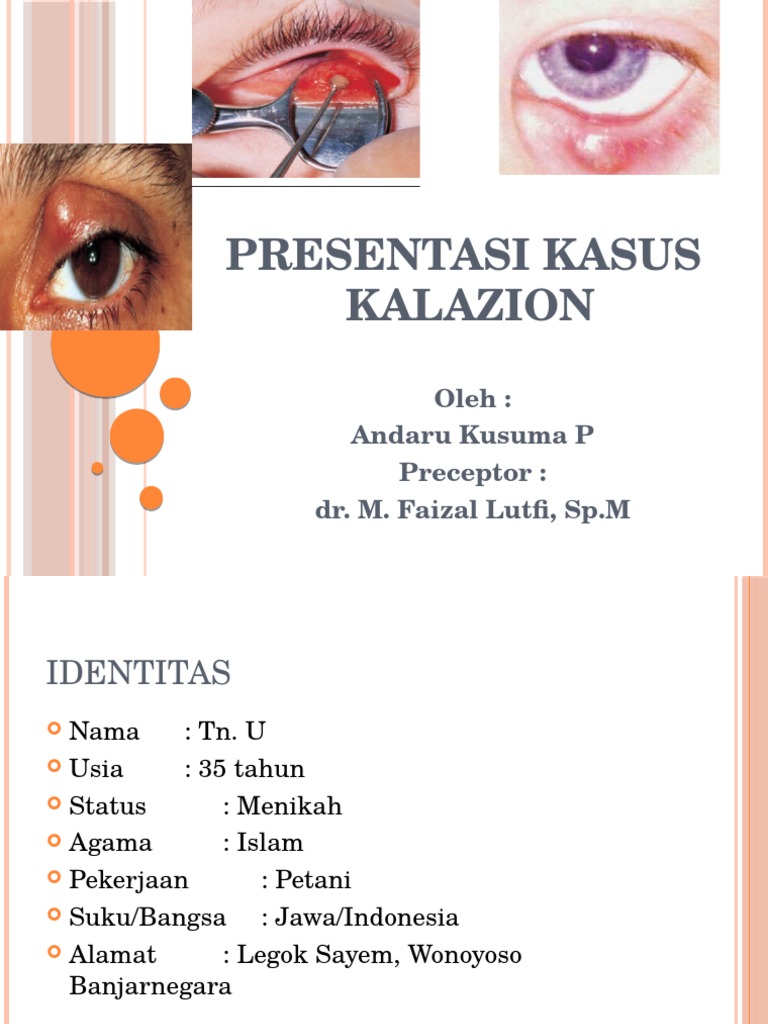 Penanganan Kalazion pada Palpebra | PDF