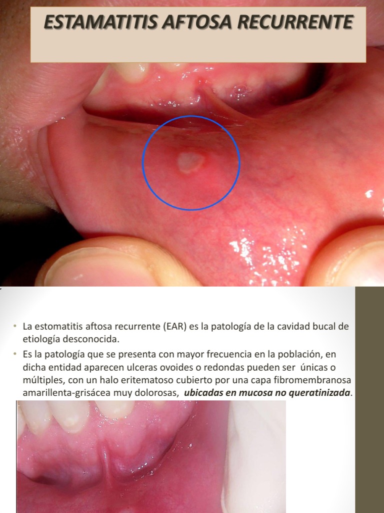 Estomatitis Aftosa Recurrente | PDF | Inmunología | Epidemiología