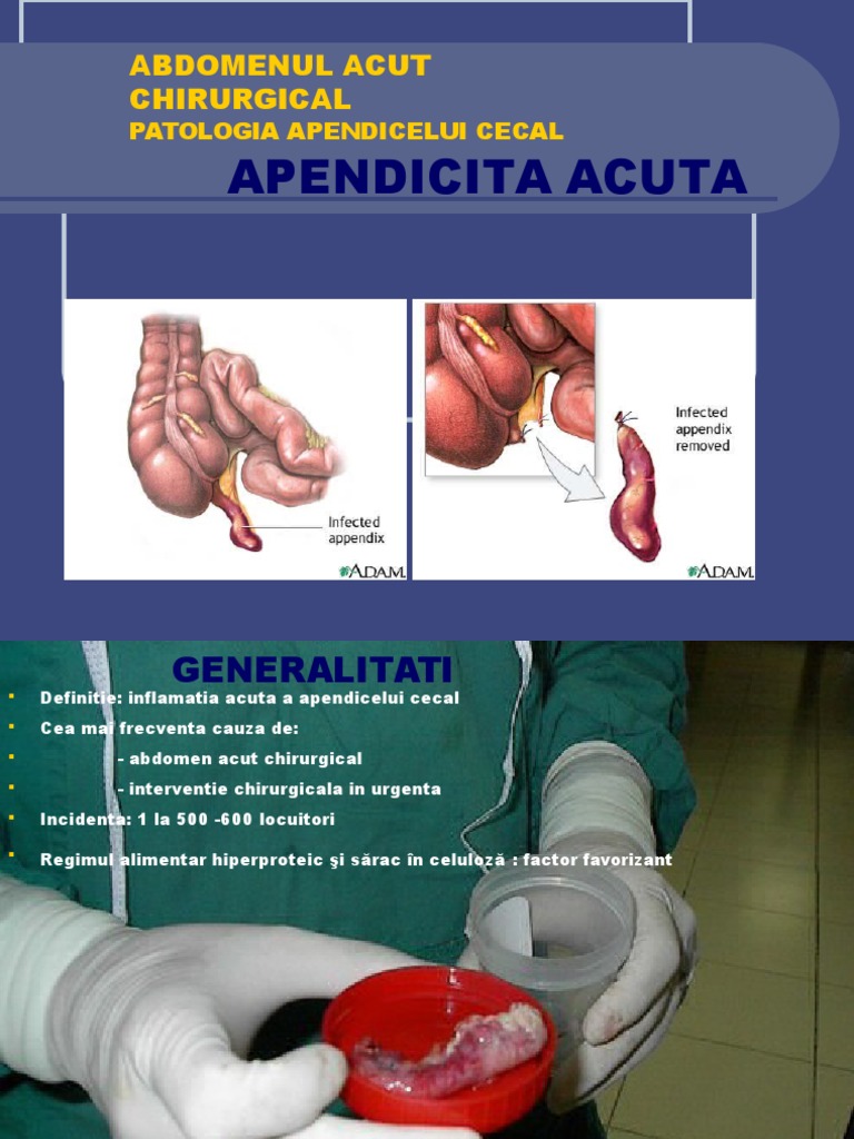 1 Apendicita-Acuta | PDF