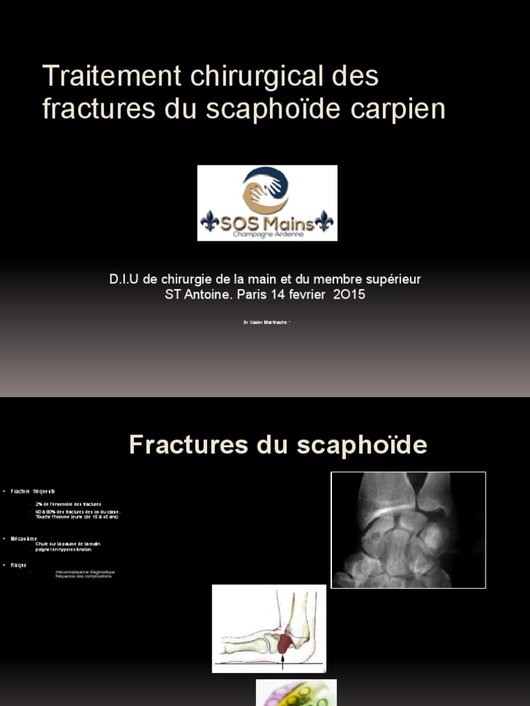 Traitement des fractures du scaphoïde | PDF | Orthopédie | Système ...