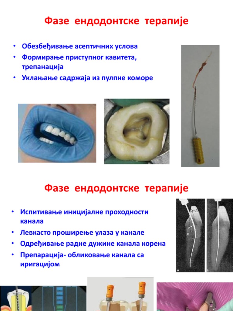 Instrumentacija Kanala Korena Zuba