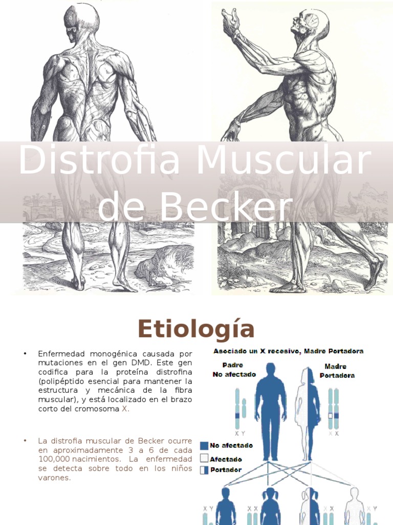 Distrofia Muscular de Becker