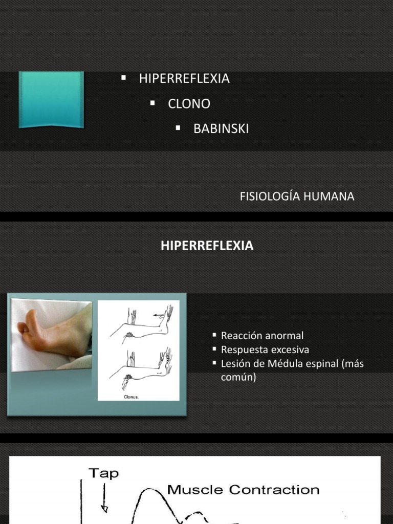 Términos Hiperreflexia, Clonus y Babinski | PDF | Enfermedades y ...
