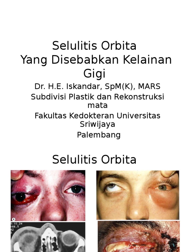 Selulitis Orbita | PDF