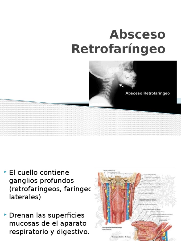 Absceso Retrofaríngeo | Sistema linfático | Ct Scan
