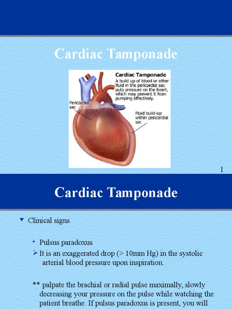 Cardiac Tamponade Guideline | PDF