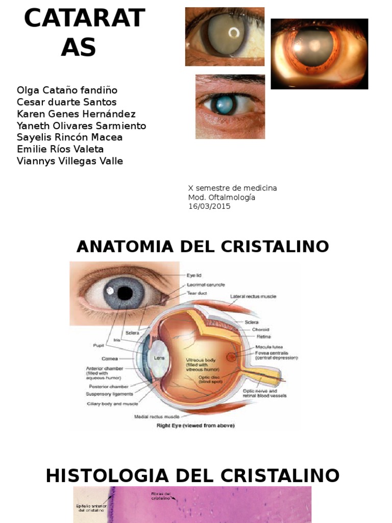 Cataratas: Causas y Tratamientos | PDF | Catarata | Ojo humano