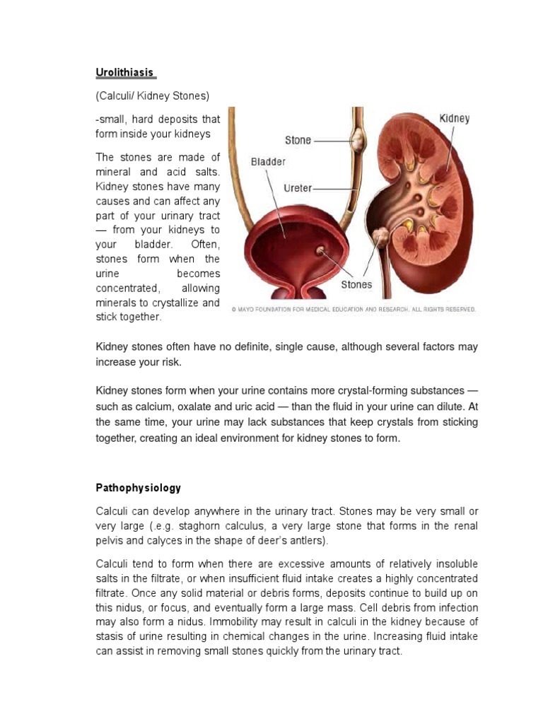 Urolithiasis | Kidney | Diseases And Disorders | Free 30-day Trial | Scribd