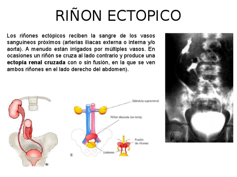 Riñon Ectopico | PDF