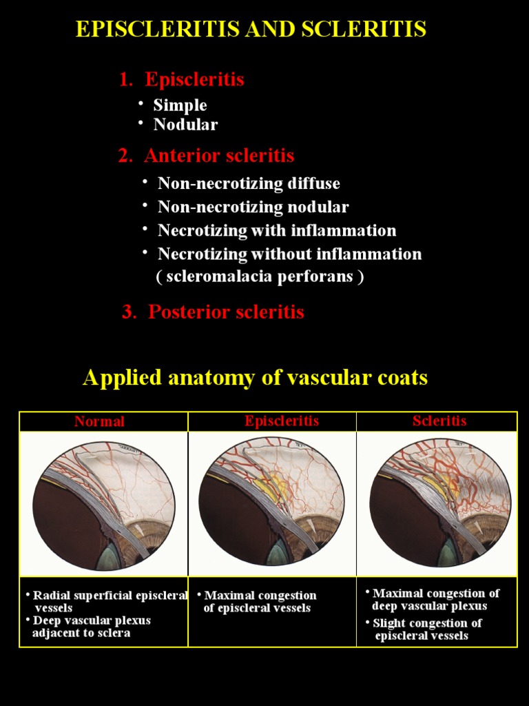 21Episcleritis & Scleritis.ppt | Medical Specialties | Diseases And Disorders