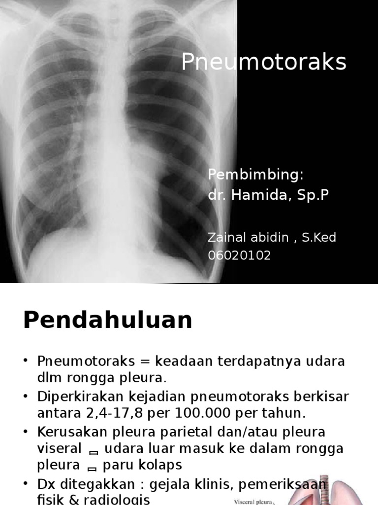 PNEUMOTORAKS: PENYAKIT, GEJALA, DIAGNOSIS DAN PENANGANANNYA | PDF