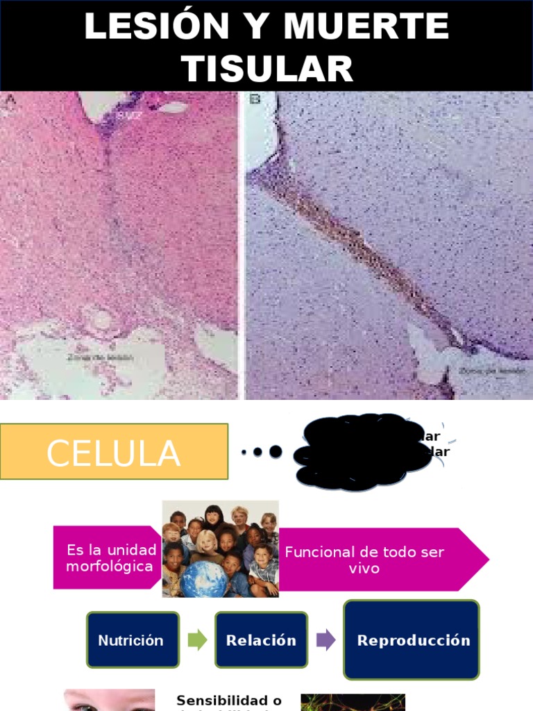 Lesion Tisular | PDF | Edema | Inflamación