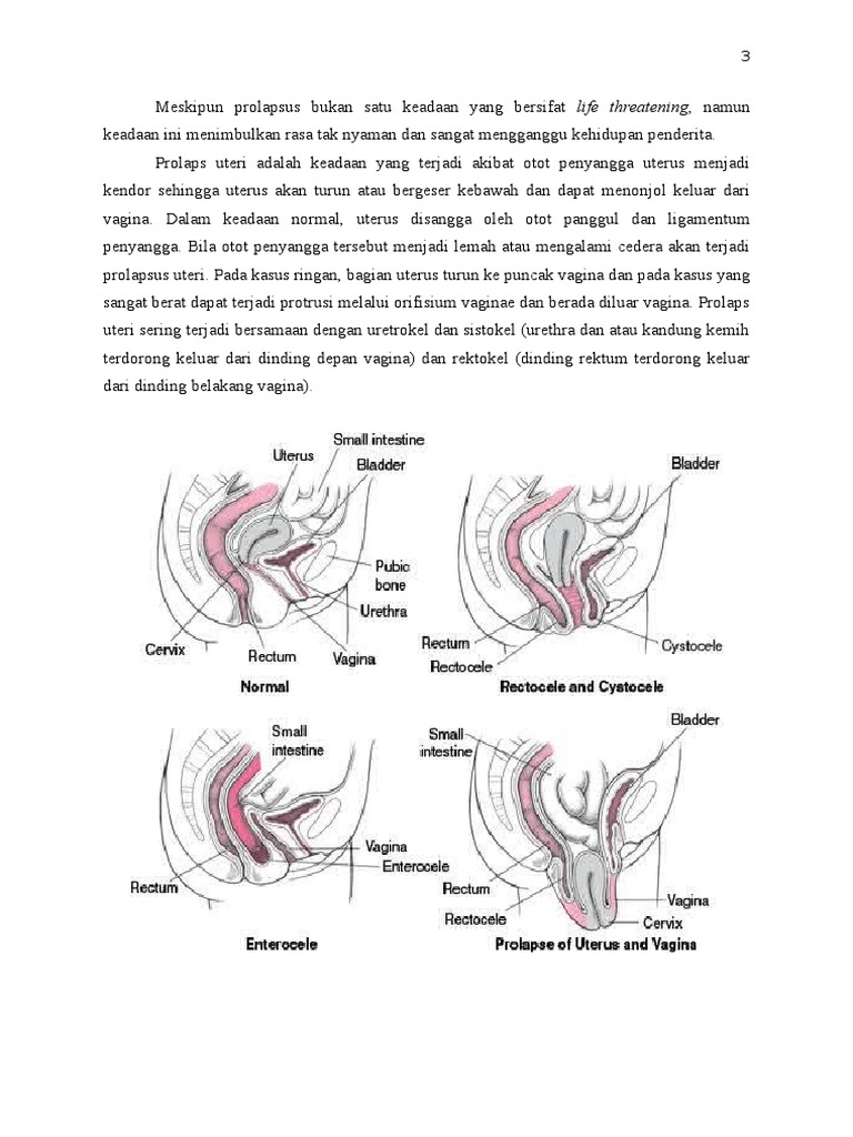 Panduan Prolaps Uteri dan Klasifikasinya | PDF | Sains & Matematika