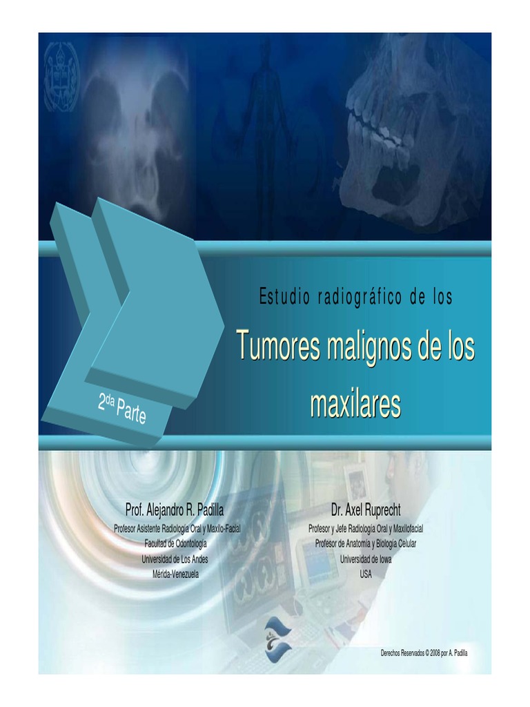 Tumores Malignos de Los Maxilares RX | PDF | Sarcoma | Neoplasias