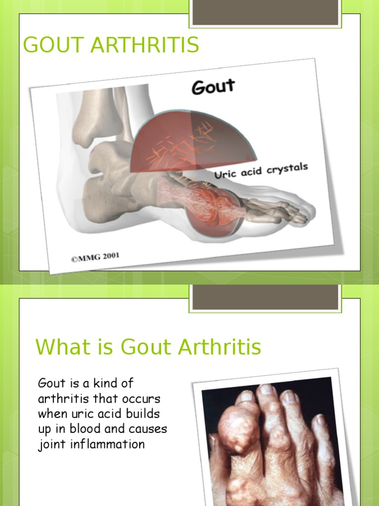 Gout Arthritis | PDF